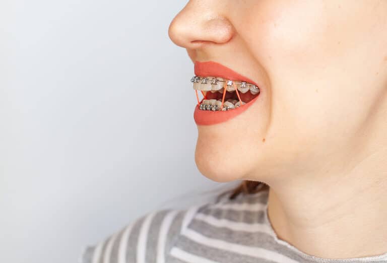Anatomy of Braces - Gibbs Orthodontics