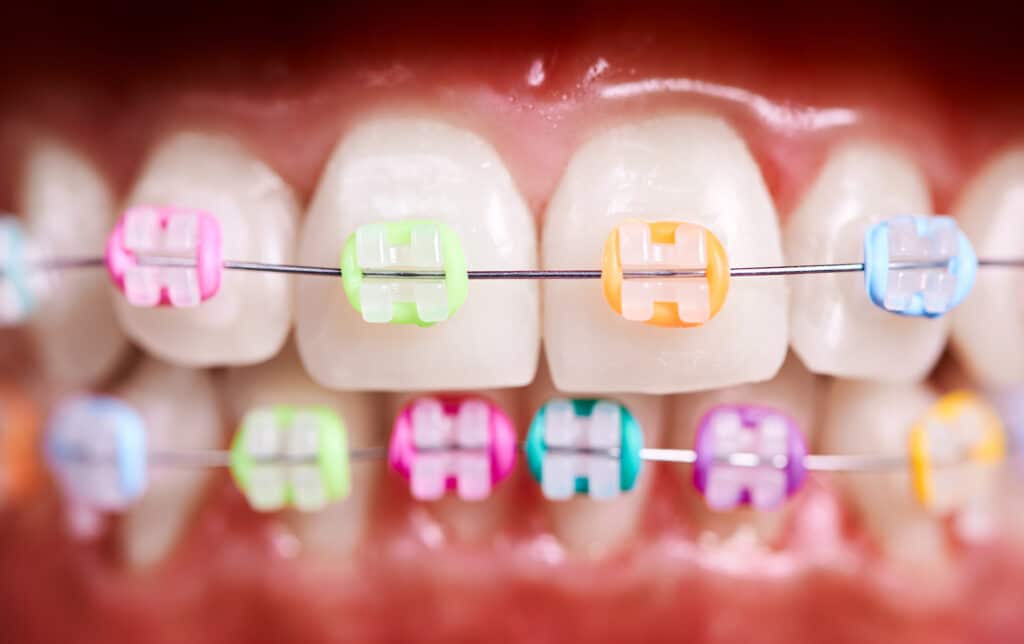 Anatomy of Braces - Gibbs Orthodontics