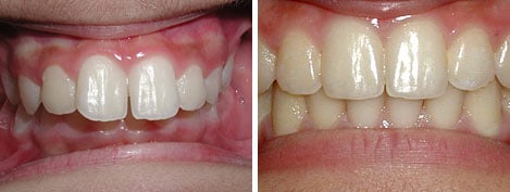 Braces for Adults Upper East Side | Gibbs Orthodontics