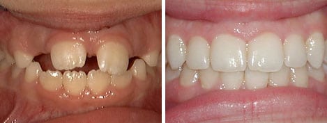 Braces for Adults Upper East Side | Gibbs Orthodontics