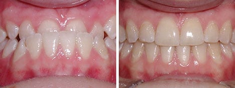 Braces for Adults Upper East Side | Gibbs Orthodontics