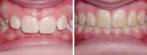 Braces for Adults Upper East Side | Gibbs Orthodontics