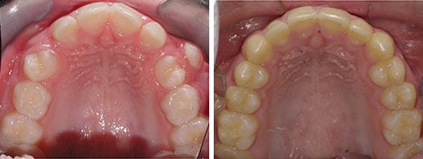 Braces for Adults Upper East Side | Gibbs Orthodontics