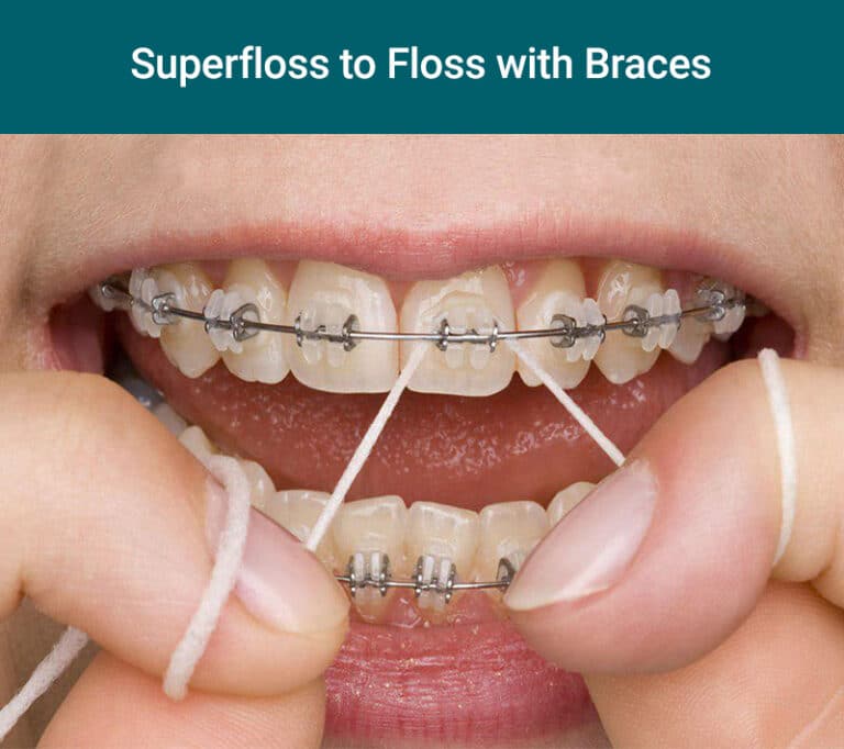 How to Floss With Braces - Gibbs Orthodontic Associates