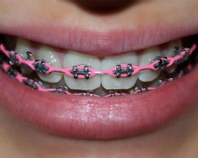 Braces And Power Chains - Gibbs Orthodontic Associates