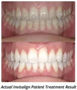 Teeth Whitening - Gibbs Orthodontic | Manhattan New York NY