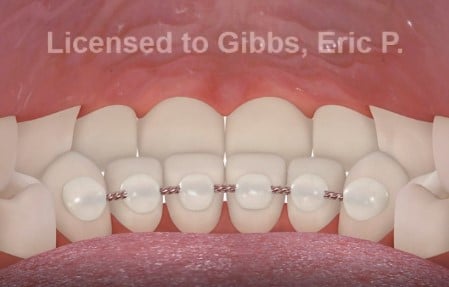 Cool Retainers After Braces